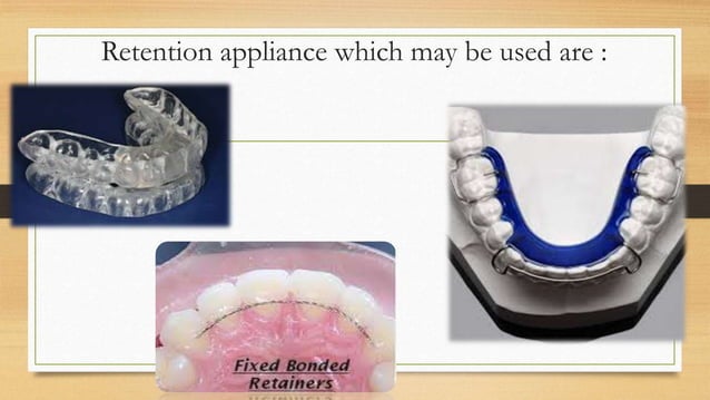 Rotation of teeth & its management | PPTX | Oral care | Personal Care