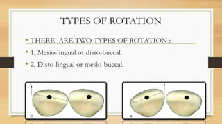 Rotation of teeth & its management | PPTX