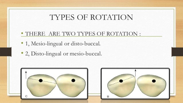 Rotation of teeth & its management