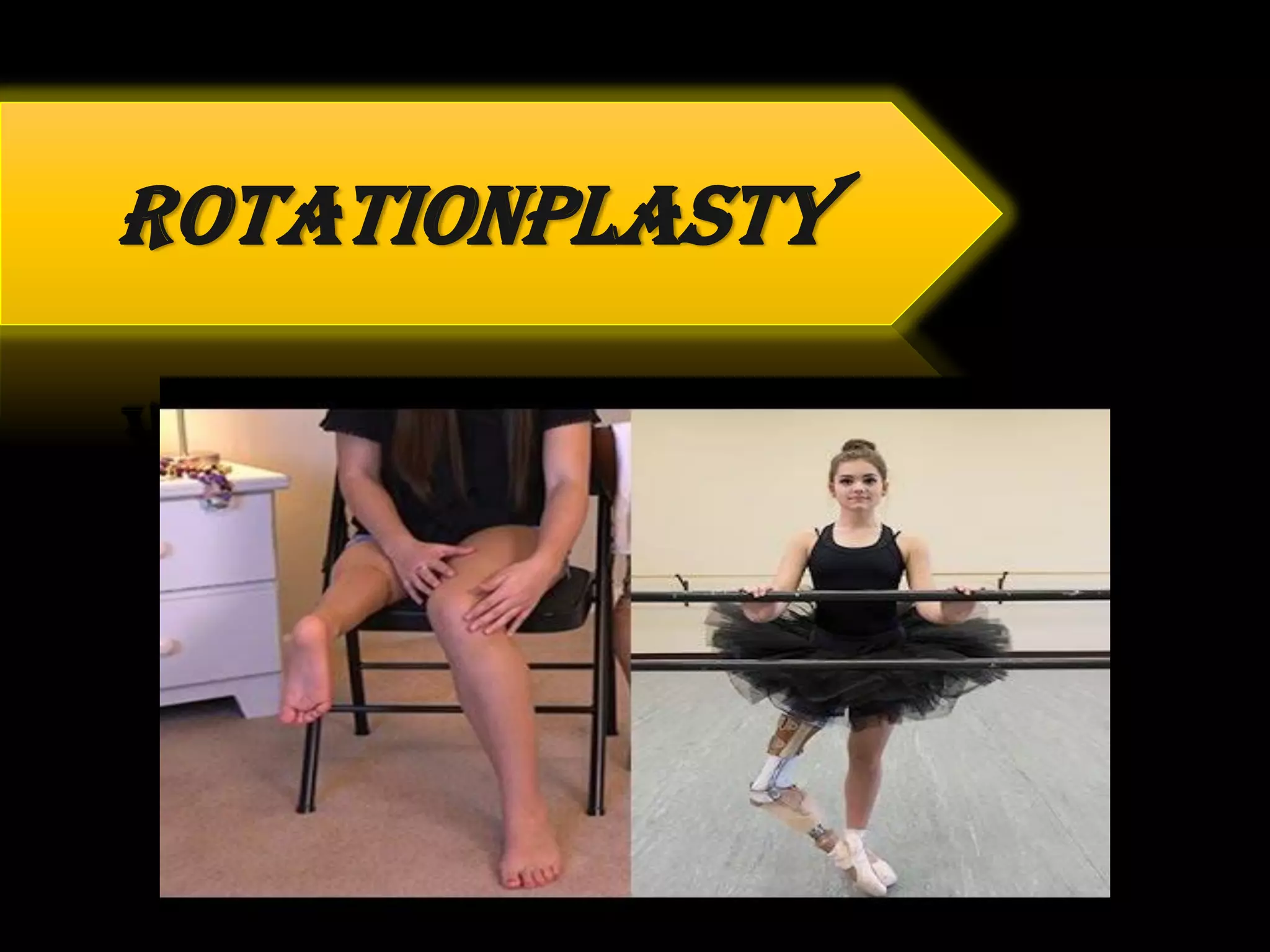 Rotationplasty | PDF