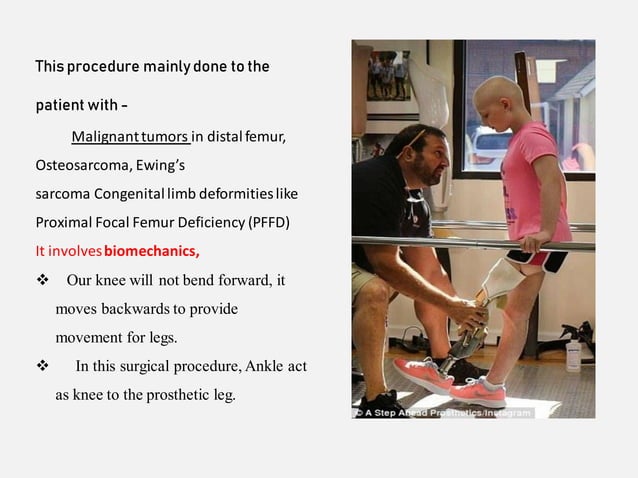 Rotationplasty | PDF | Bone and Joint Conditions | Diseases and Conditions