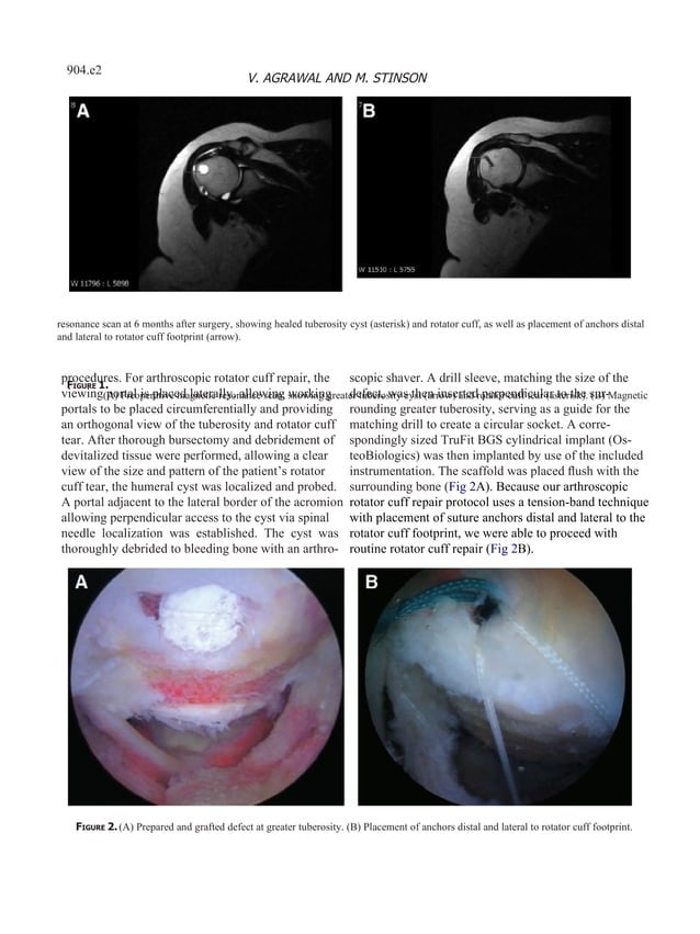 Rotator cuff-repair | PDF