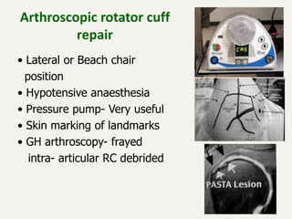 Rotator cuff Tear and its management | PPTX