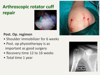 Rotator cuff Tear and its management | PPTX