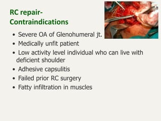 Rotator cuff Tear and its management | PPTX
