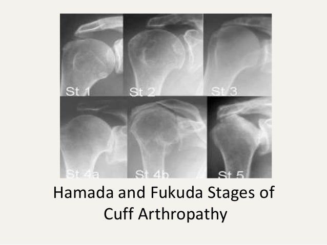 Rotator cuff Tear and its management