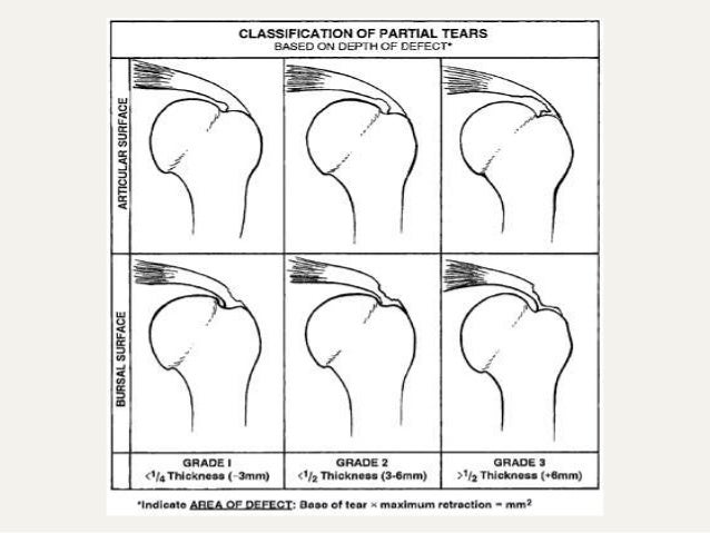 Rotator cuff Tear and its management