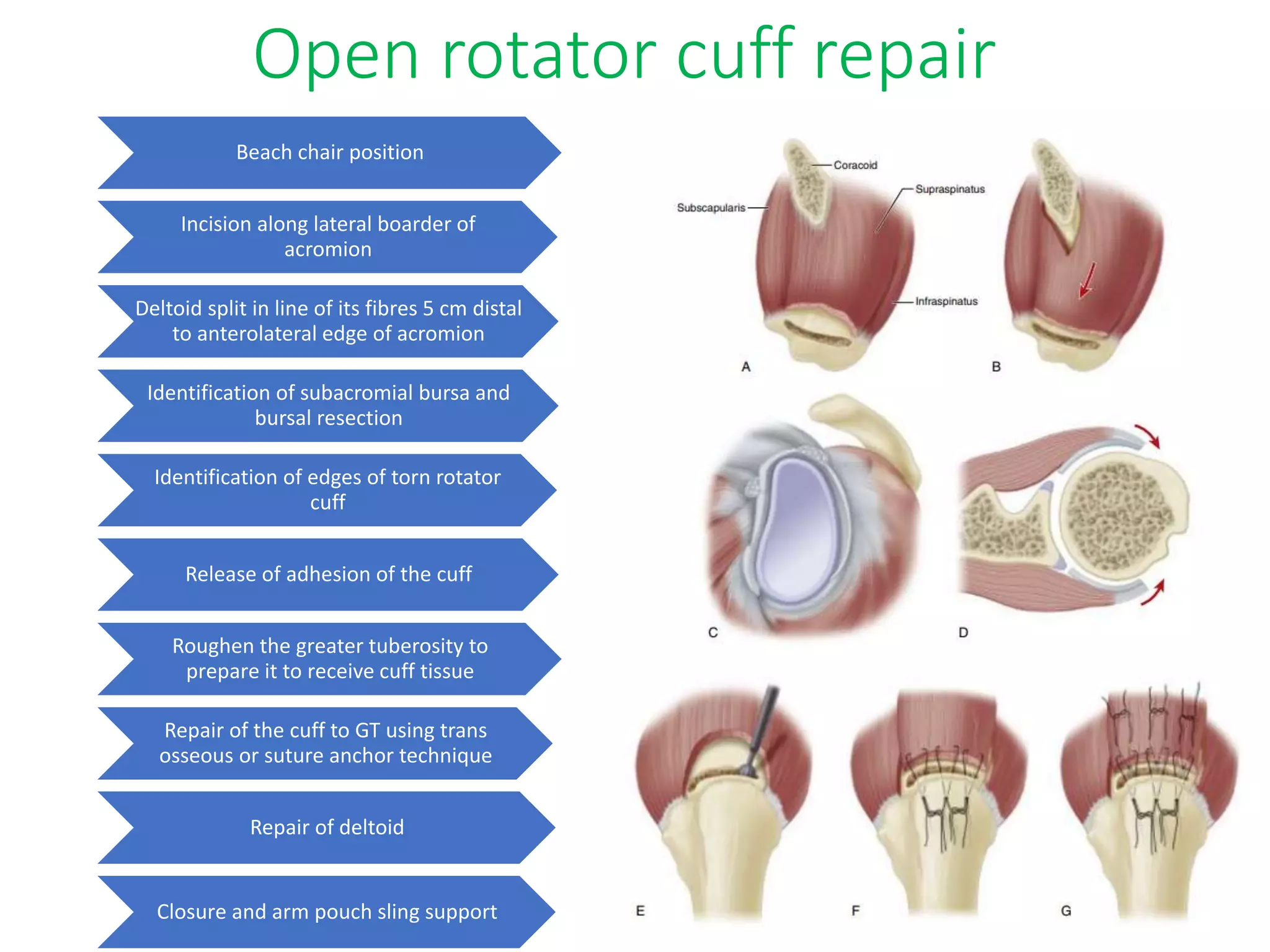 Rotator cuff disorders, bicipital tendinopathies | PPTX