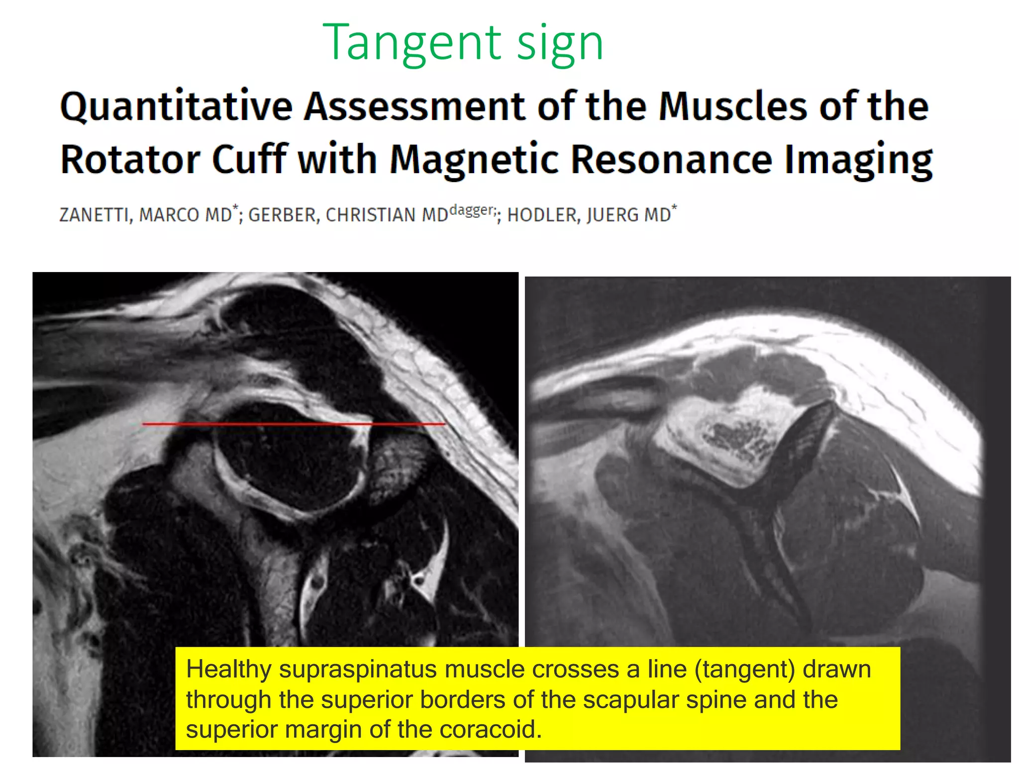 Rotator cuff disorders, bicipital tendinopathies | PPTX