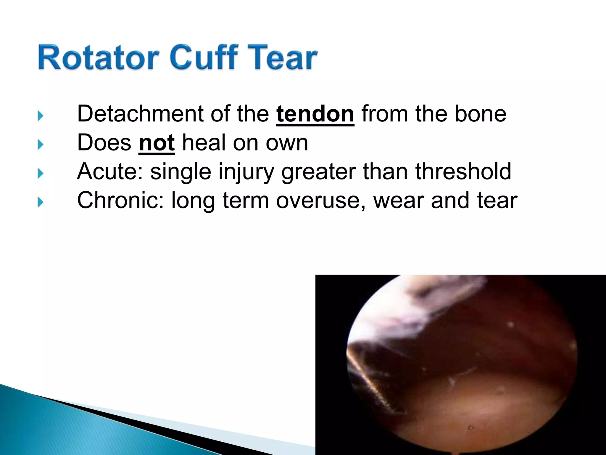 Rotator cuff disorder | PPTX