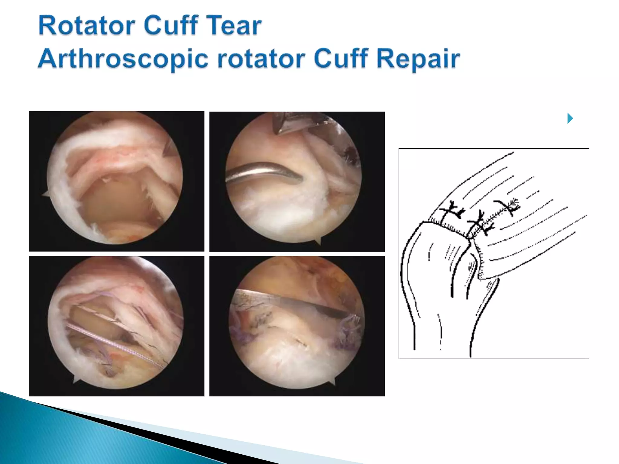 Rotator cuff disorder | PPTX