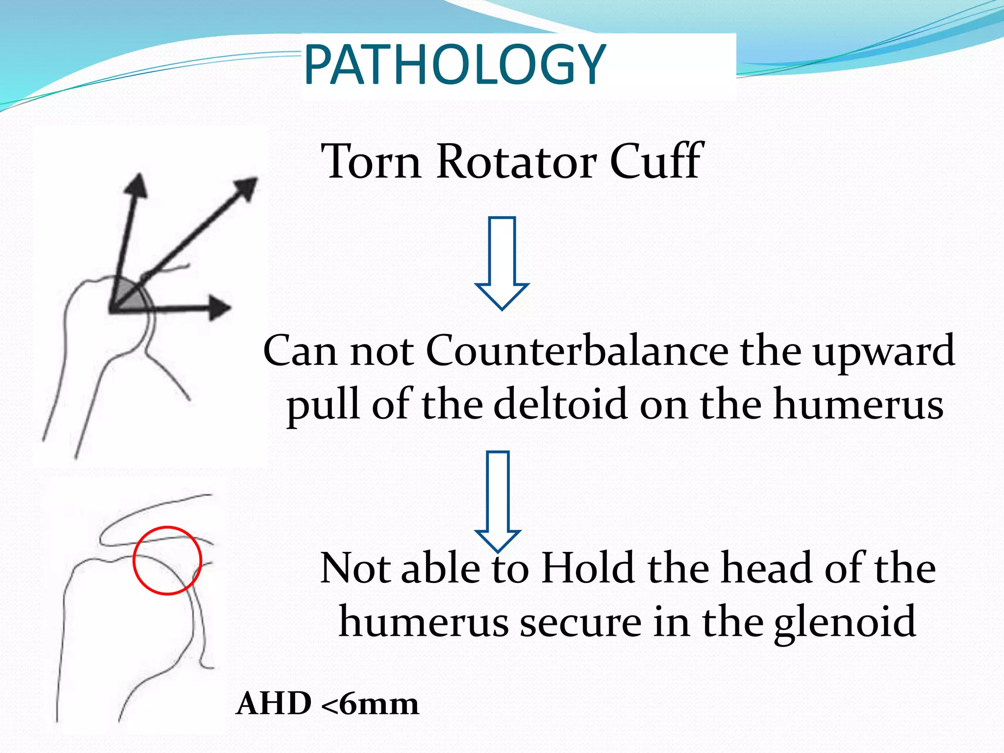 Rotator cuff injuries | PPTX