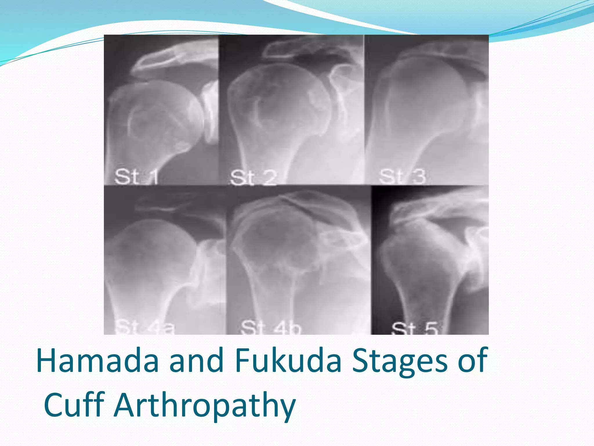 Rotator cuff injuries | PPTX
