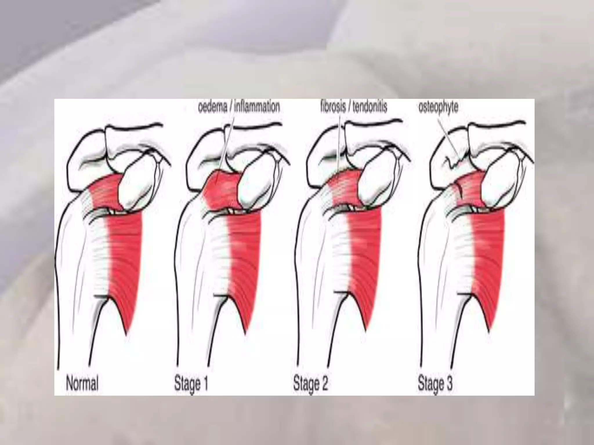 rotator cuff injuries.pptx