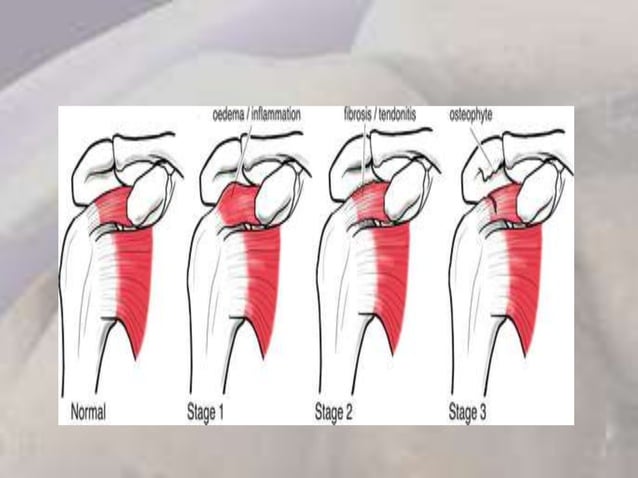 rotator cuff injuries.pptx