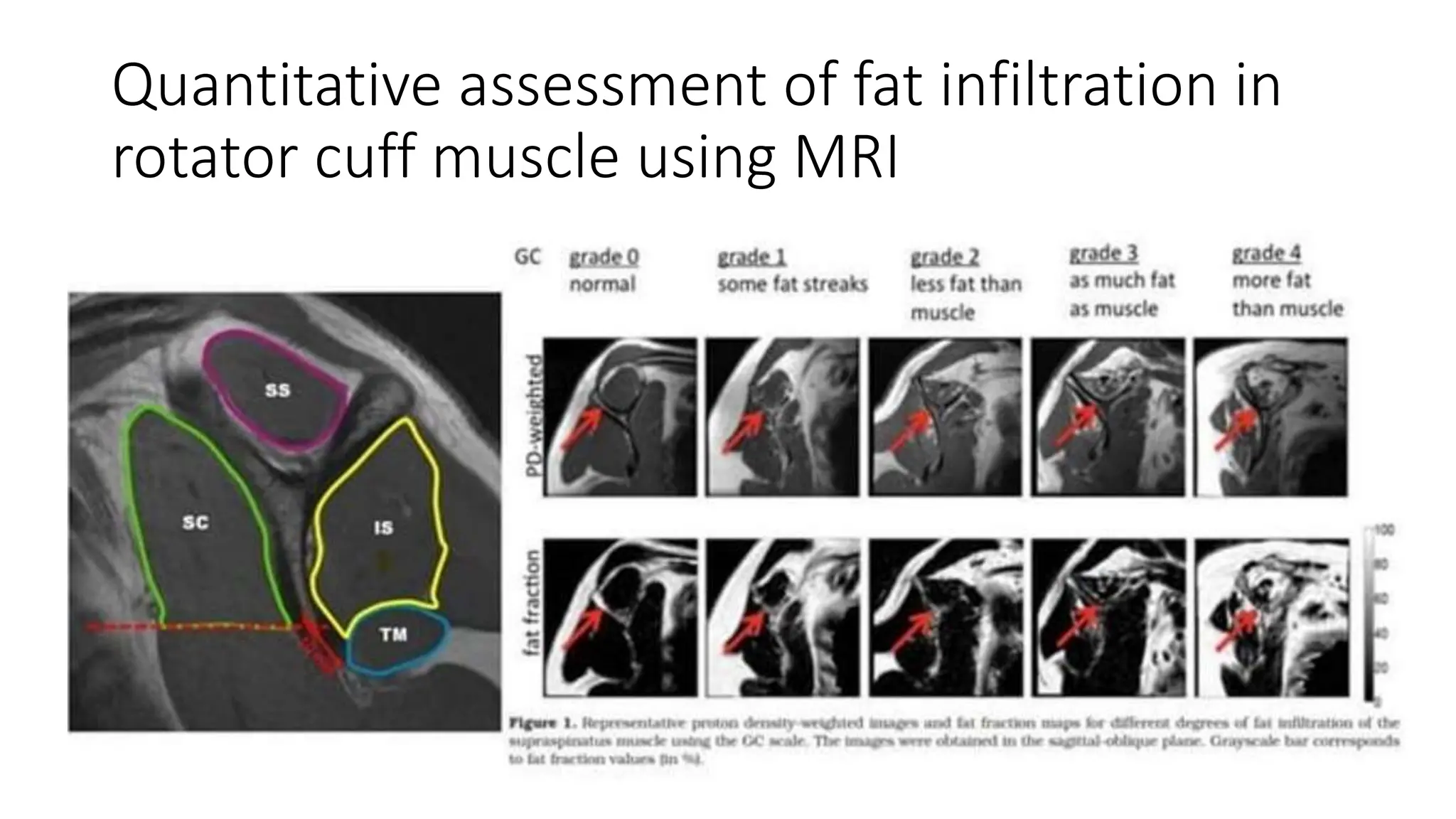 Rotator Cuff Injuries present at Chirayu Medical College.pptx