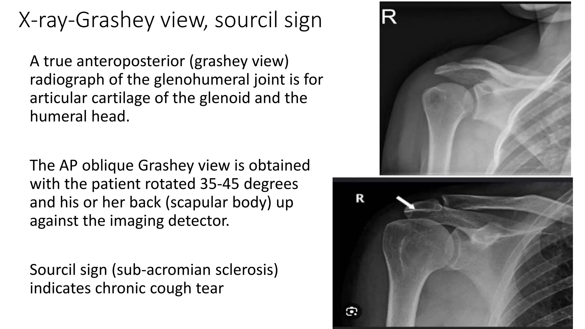 Rotator Cuff Injuries present at Chirayu Medical College.pptx