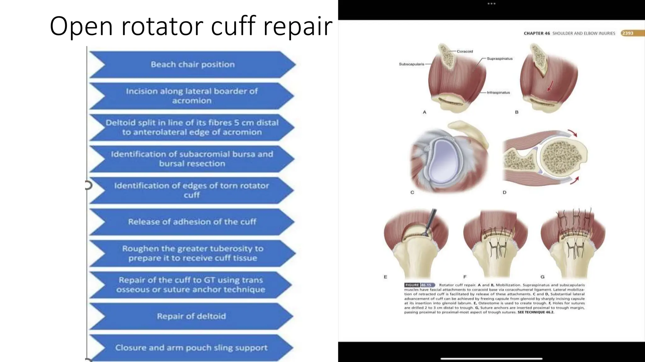 Rotator Cuff Injuries present at Chirayu Medical College.pptx