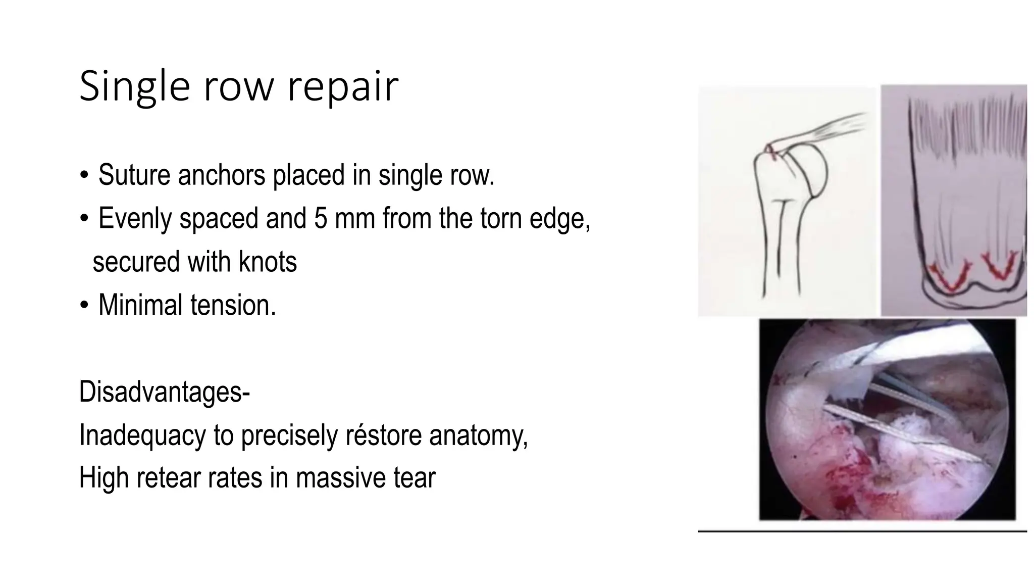 Rotator Cuff Injuries present at Chirayu Medical College.pptx