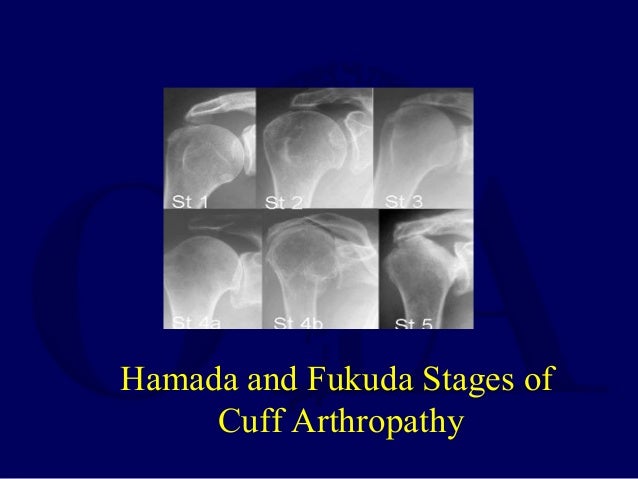 Rotator Cuff Injuries - Dr.CHINTAN N. PATEL