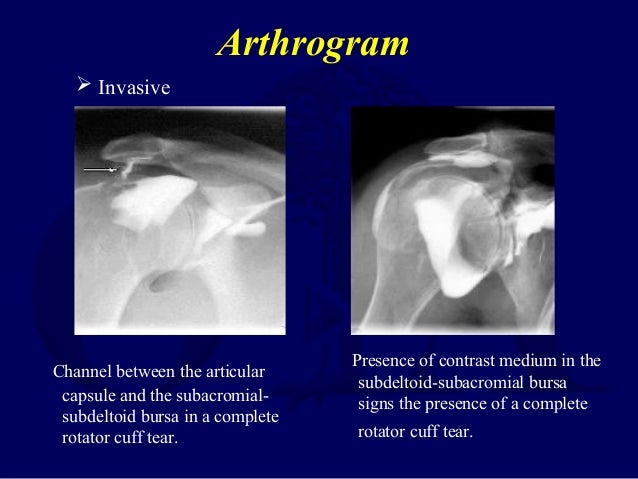 Rotator Cuff Injuries - Dr.CHINTAN N. PATEL