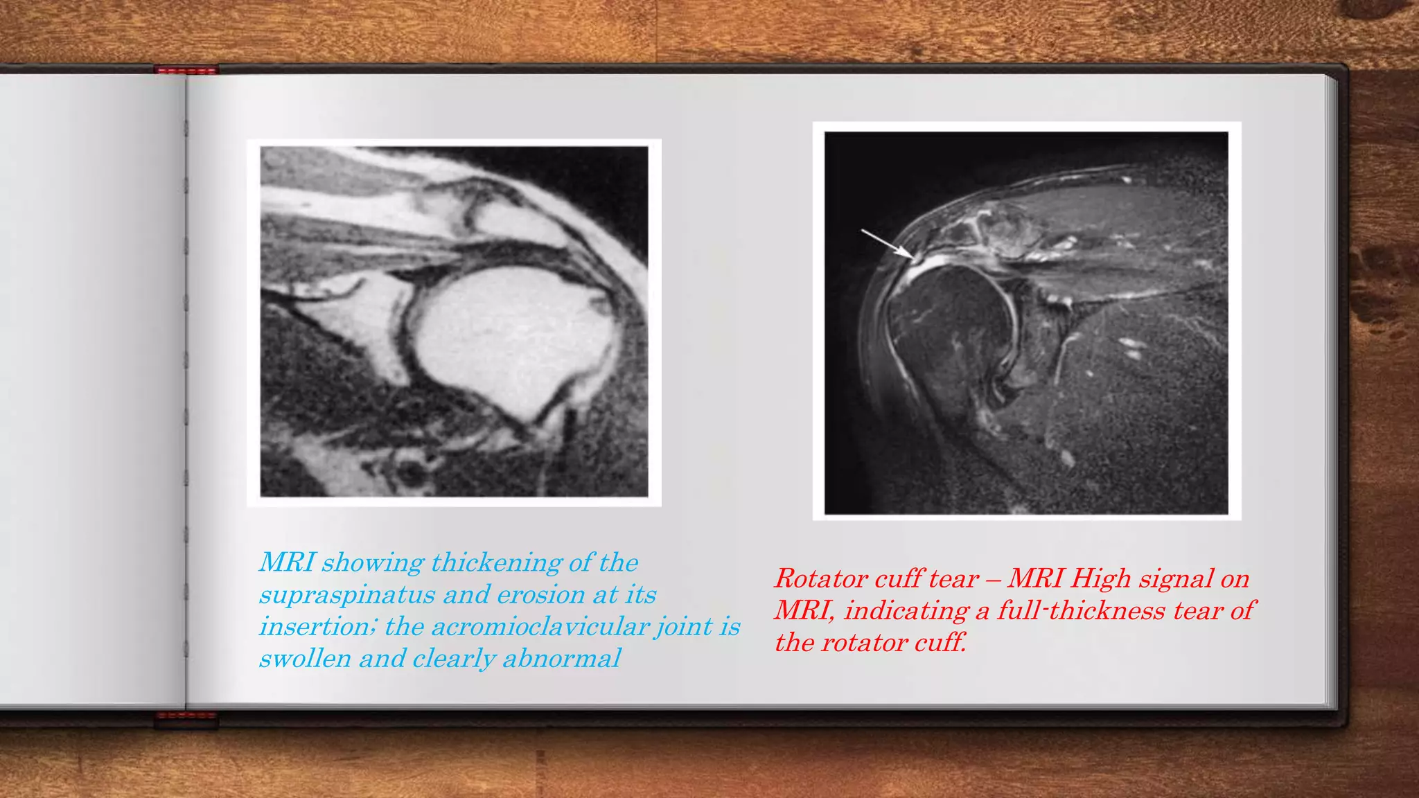 Rotator cuff ppt | PPTX