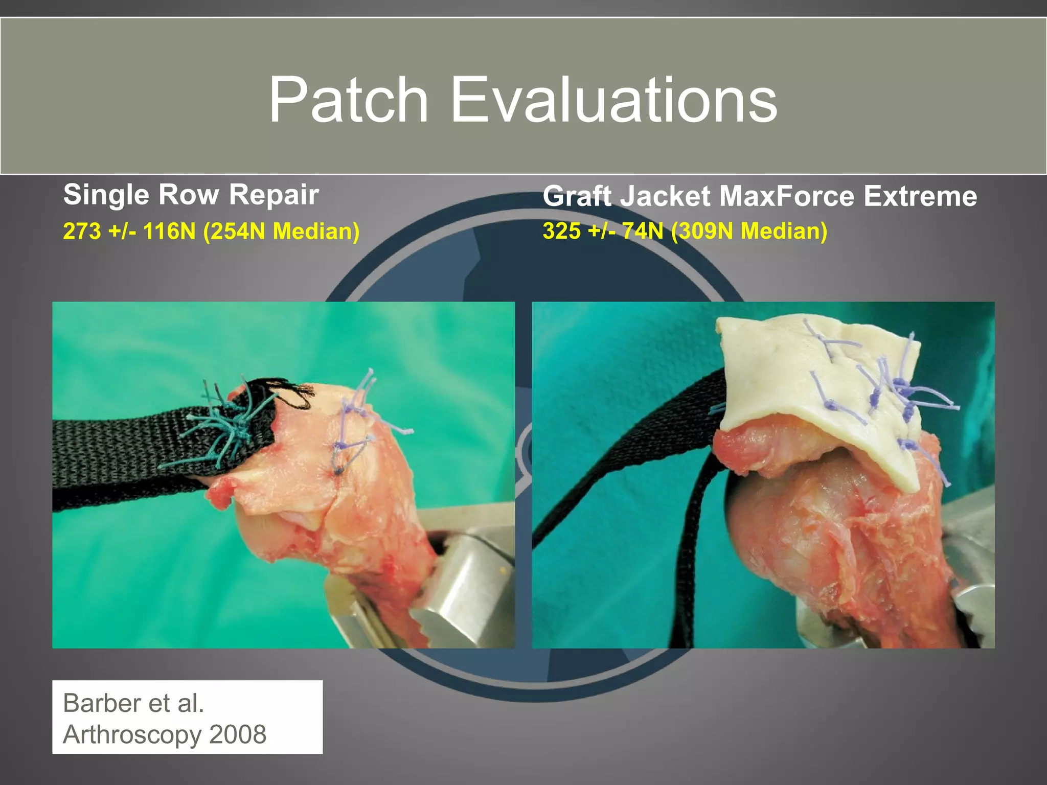 Rotator cuff Repair - New Techniques and Challenges | PPT
