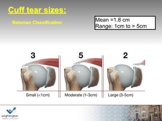 Rotator cuff Repair in Rugby 2015 funk | PPT