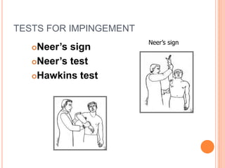 Neer And Hawkins Sign