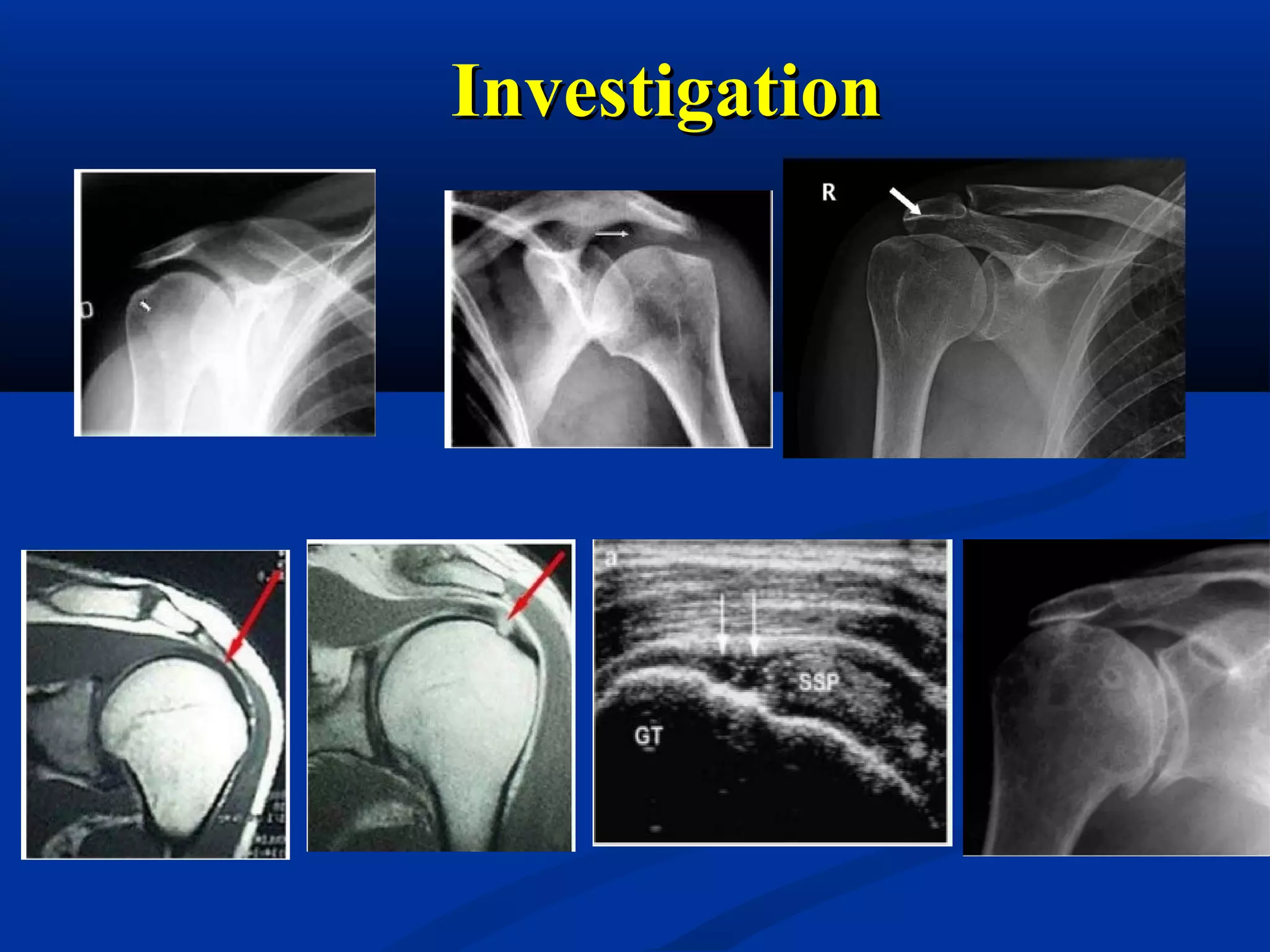 Rotatory cuff syndrome & Scapular Dyskinesia | PPT