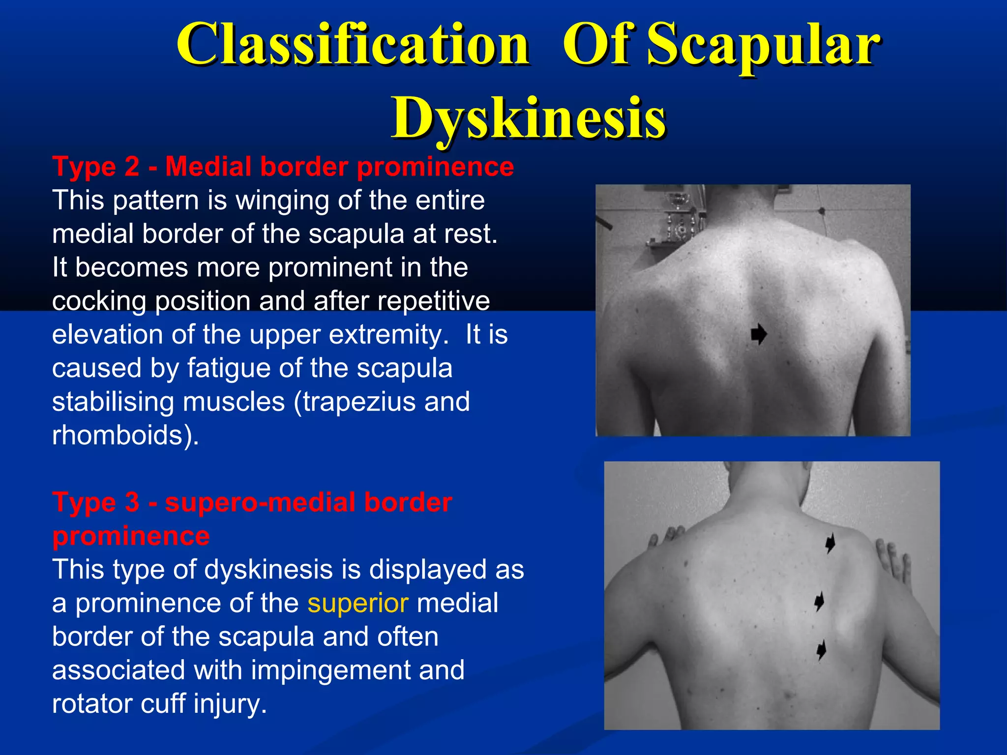 Rotatory cuff syndrome & Scapular Dyskinesia | PPT