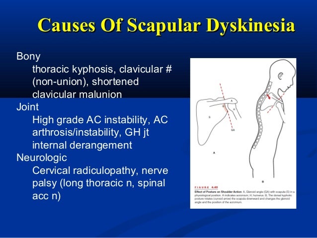 Rotatory cuff syndrome & Scapular Dyskinesia