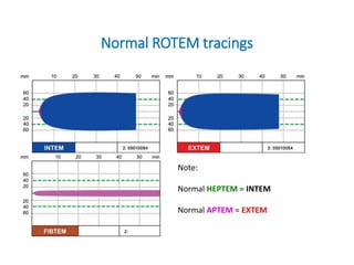 ROTEM - An Introduction and overview.pptx