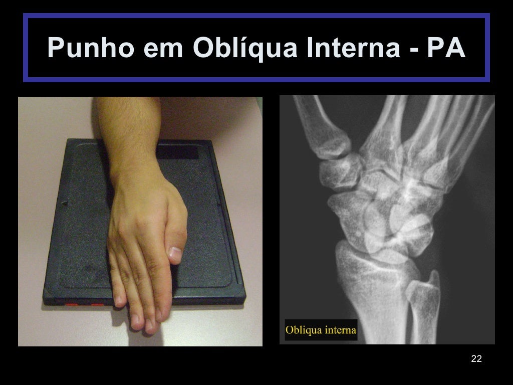 Rotinas Específicas nas Incidências do Punho