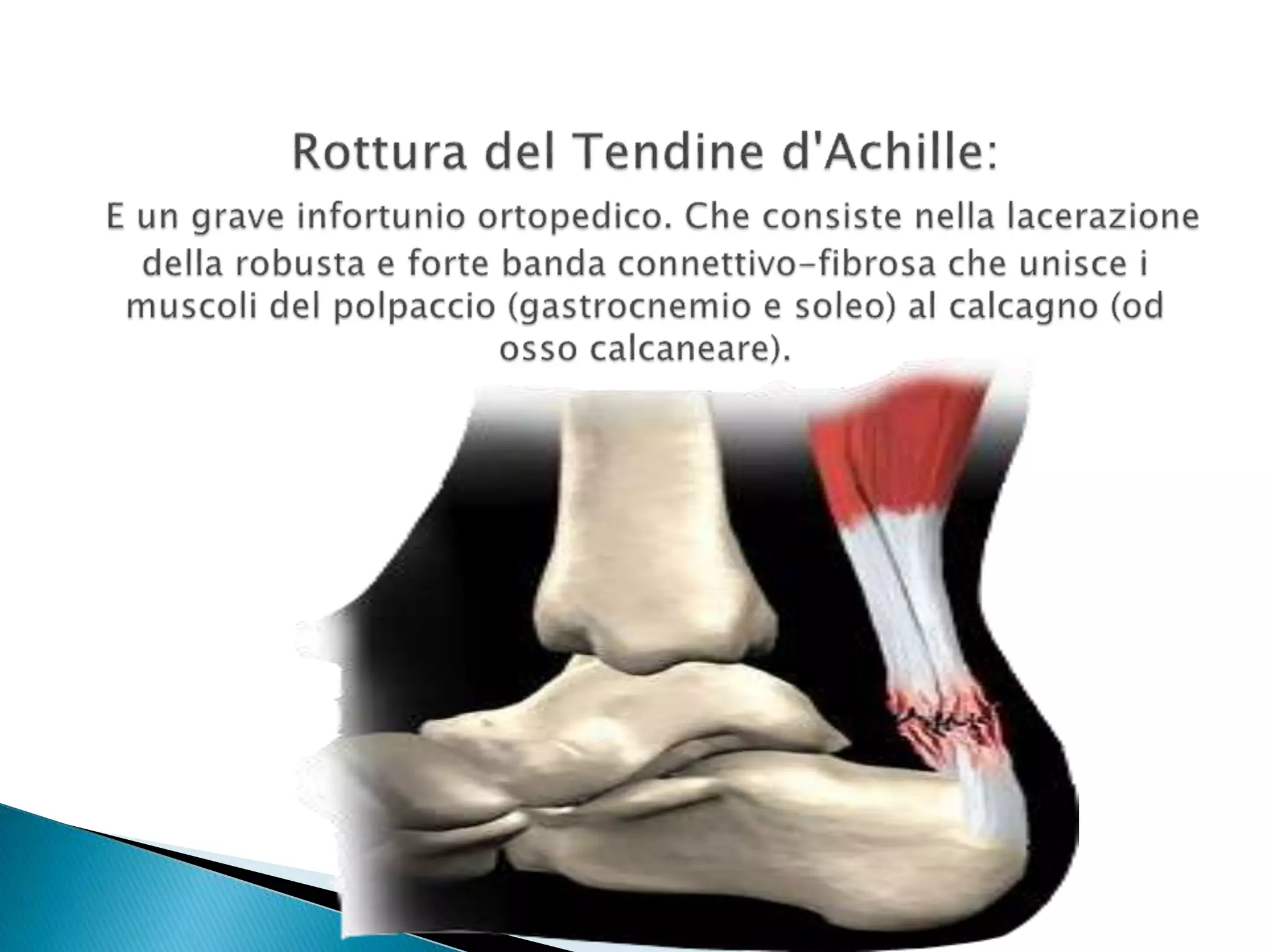 rottura del tendine d'achille.ppt