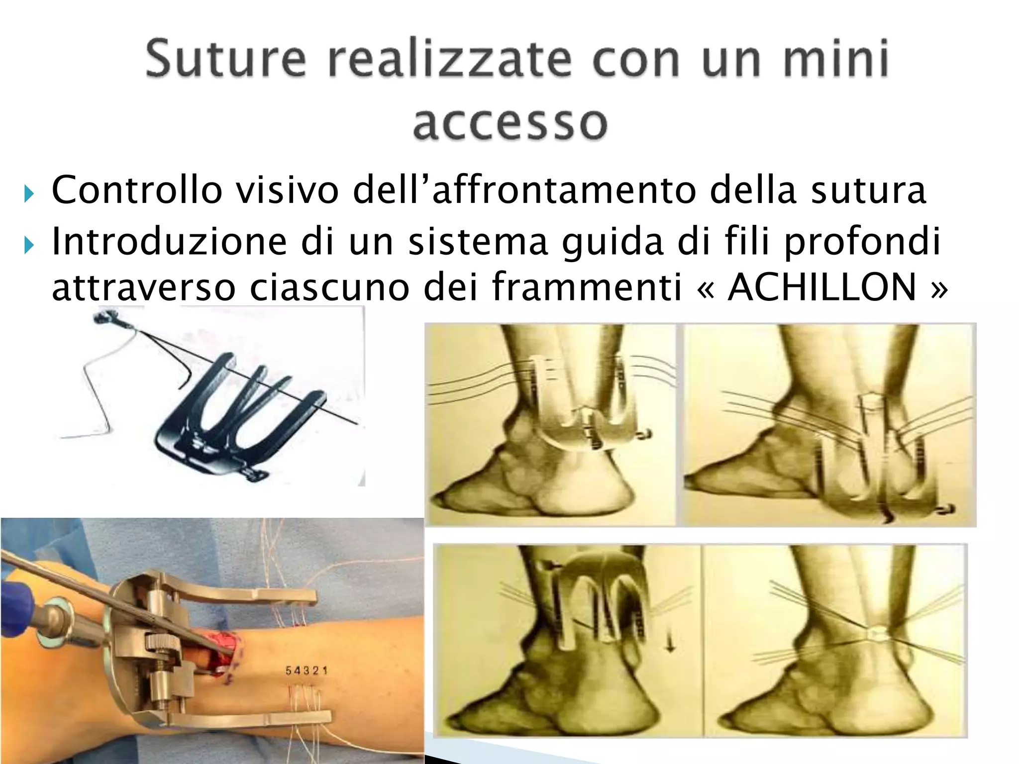 rottura del tendine d'achille.ppt