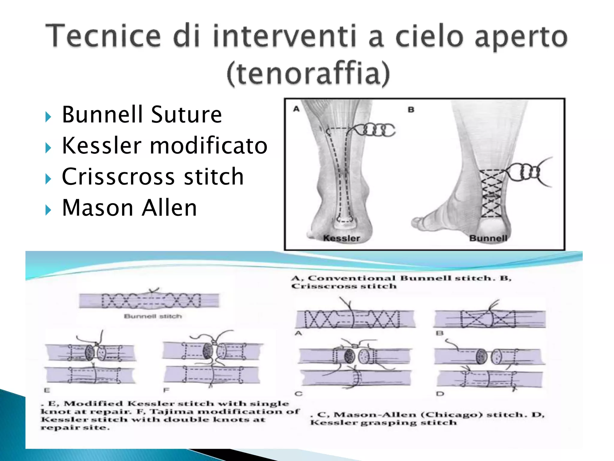 rottura del tendine d'achille.ppt