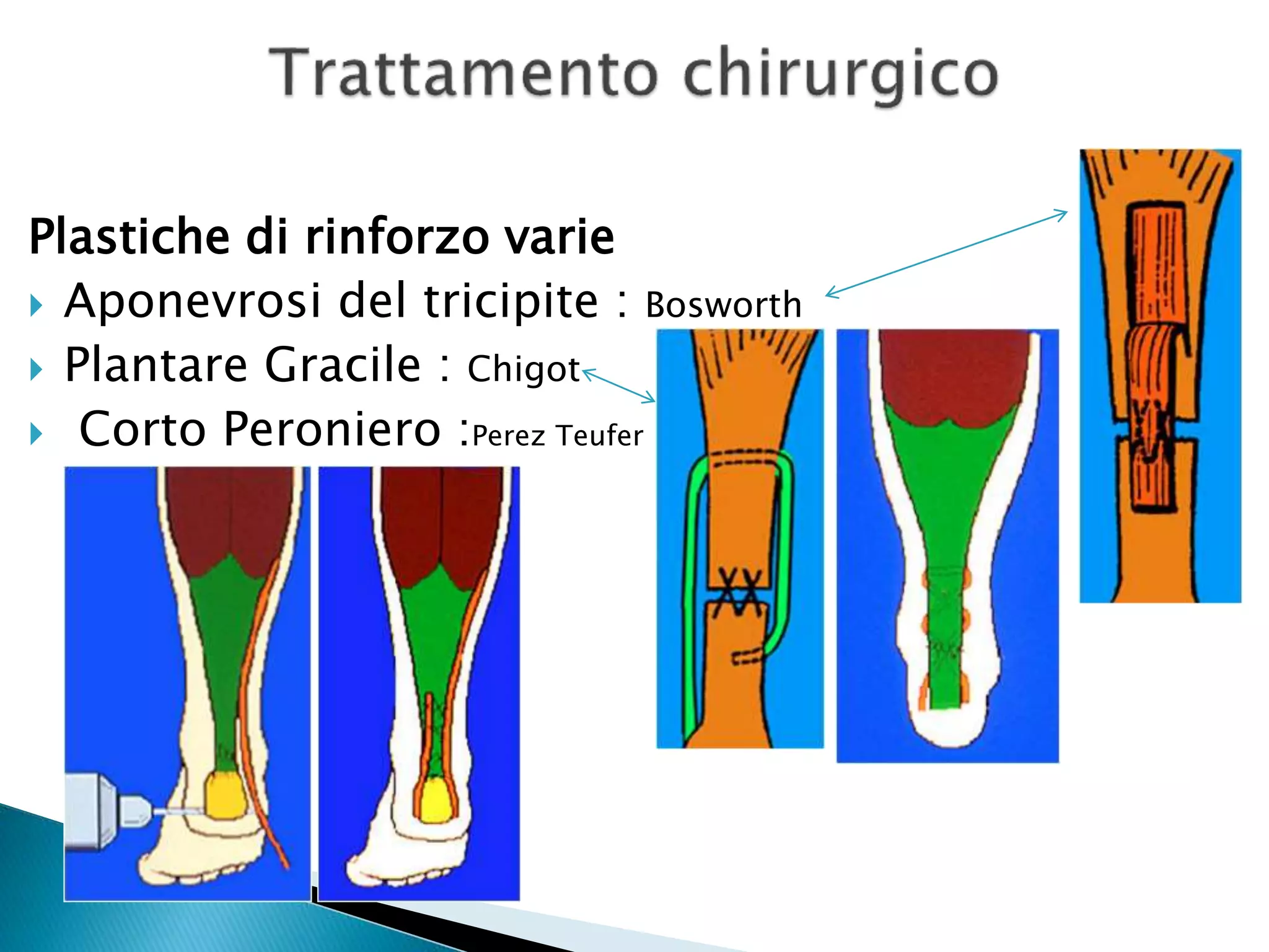 rottura del tendine d'achille.ppt