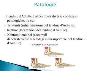 rottura del tendine d'achille.ppt