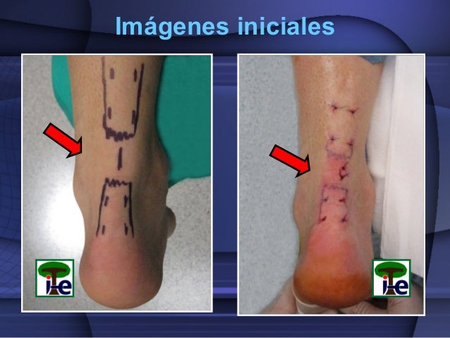 Rotura del tendón de aquiles