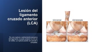 Rotura ligamento cruzado anterior.todo lo que debe saber.pptx