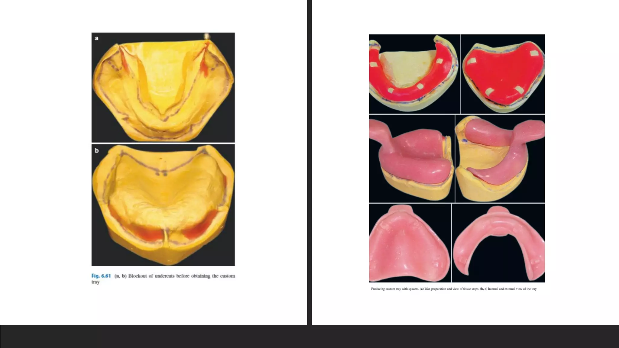Impression of complete denture | PDF