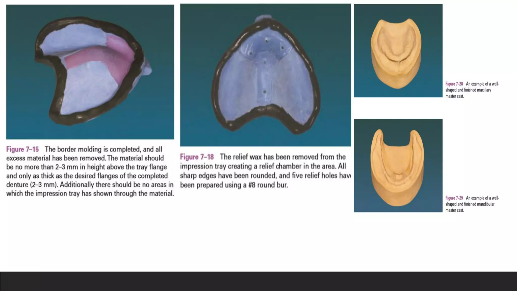 Impression of complete denture | PDF