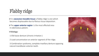Impression of complete denture | PDF