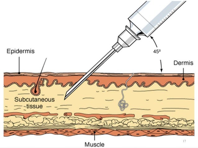Routes of parenteral administration