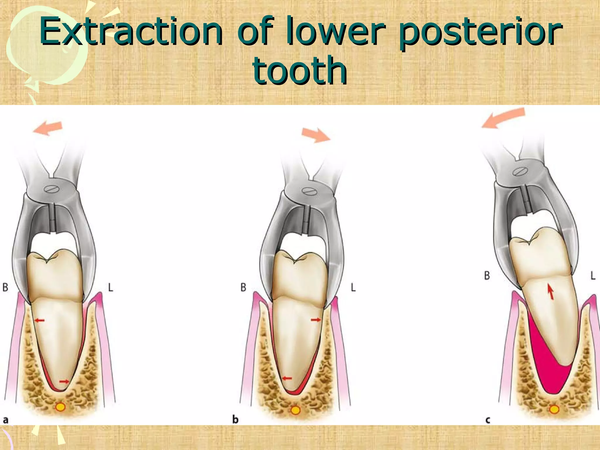 Routine extraction | PPT | Free Download