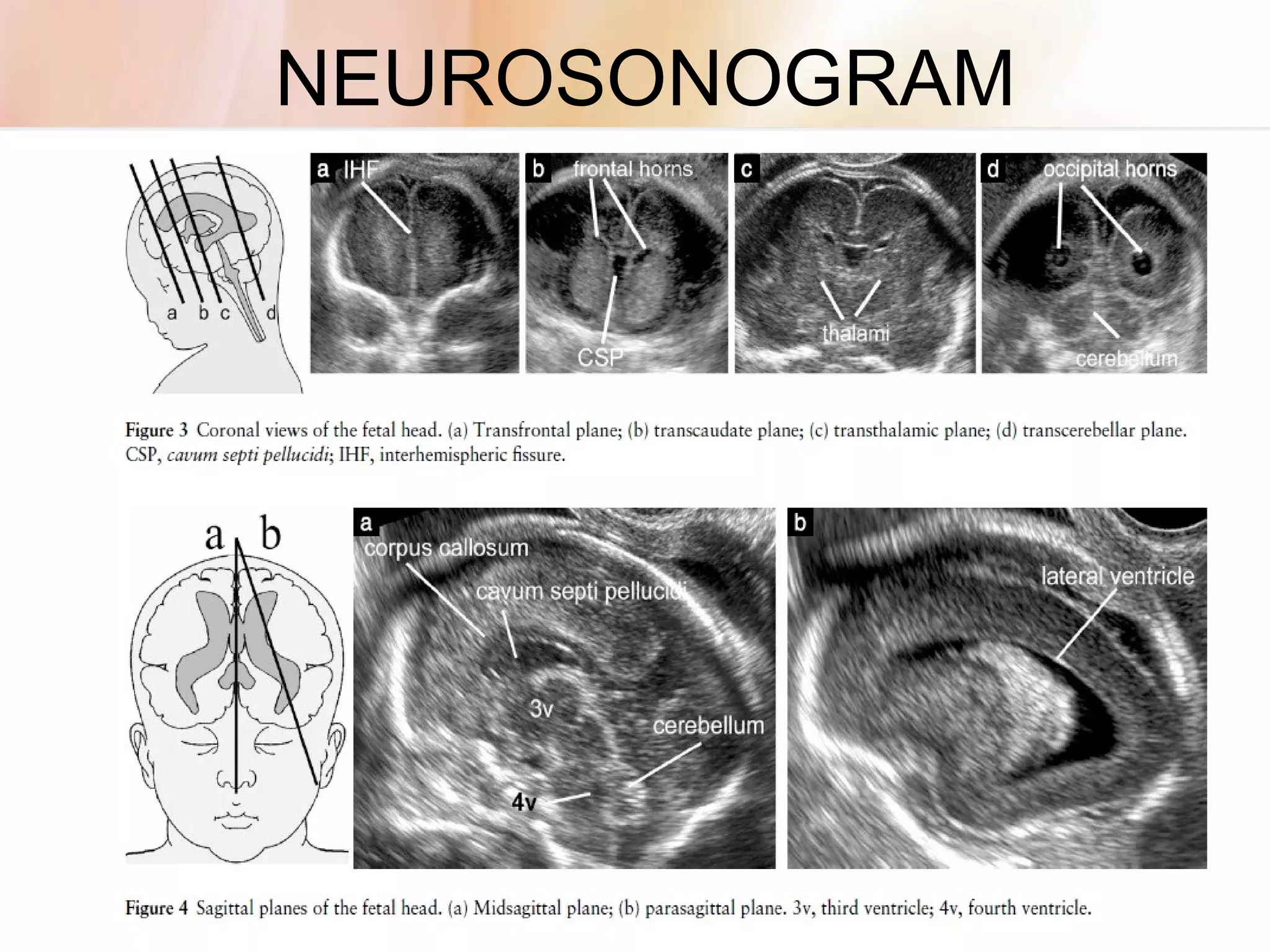 Routine fetal anatomy scan at 18-23 weeks | PPT