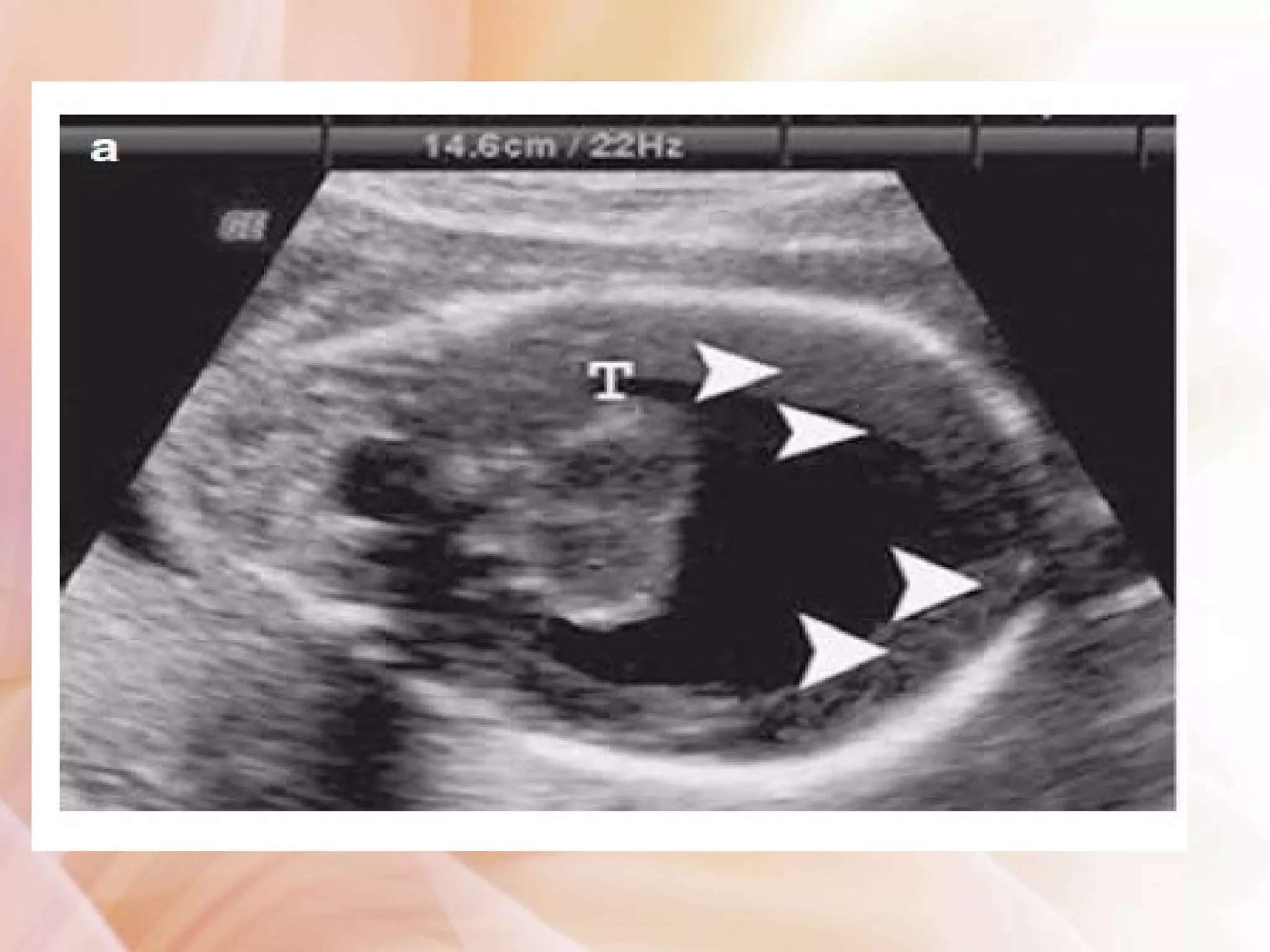 Routine fetal anatomy scan at 18-23 weeks | PPT