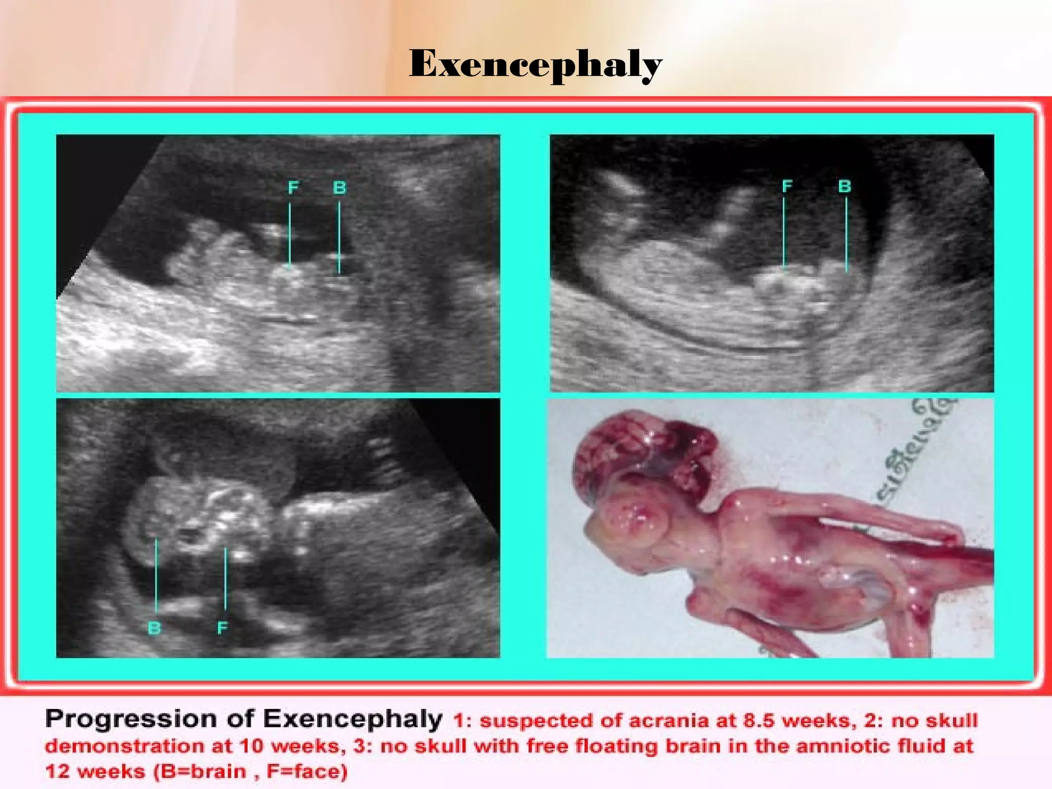 Routine fetal anatomy scan at 18-23 weeks | PPT