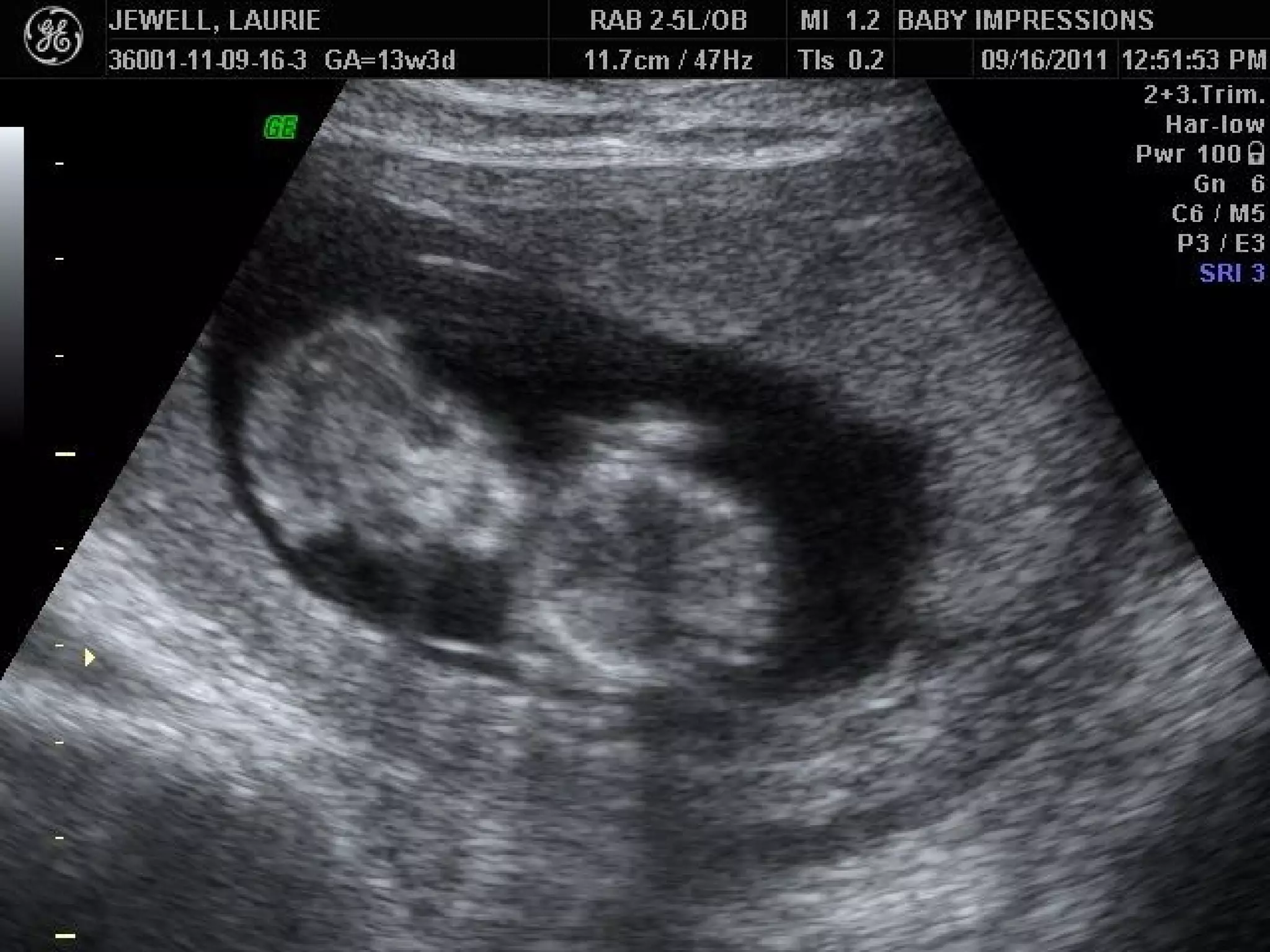 Routine fetal anatomy scan at 18-23 weeks | PPT